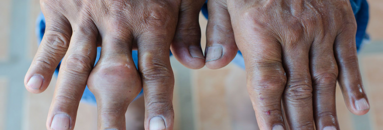 Arthrose en général : Traitement, cause et évolution